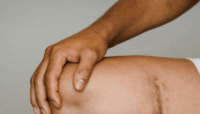 Líquido en la rodilla: causas, síntomas y tratamiento | Artrocare ...
