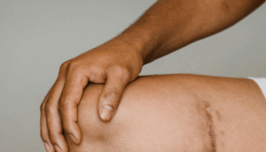 Líquido en la rodilla: causas, síntomas y tratamiento | Artrocare ...